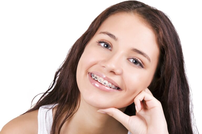 How Are Braces Put On? Everything You Need To Know - Dentistry at ...